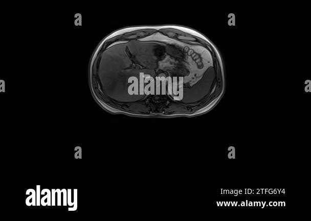 CT scan of the abdomen. Computed tomography of the gastrointestinal ...