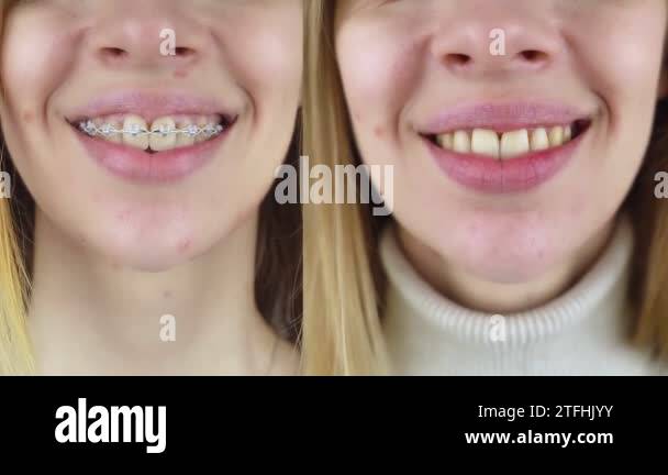 Before and after remove braces. On left is a girl in a metal bracket ...