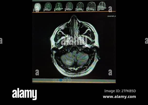 Brain mri seizure Stock Videos & Footage - HD and 4K Video Clips - Alamy