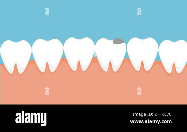 Tooth getting cavities and cracking down 4K animation. Dentist pulling ...