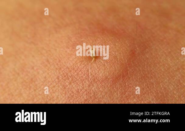 Bee's venom sac. Honey bee stings a man's arm. When the sting is over ...