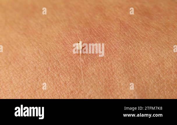 Bee's venom sac. Honey bee stings a man's arm. When the sting is over ...