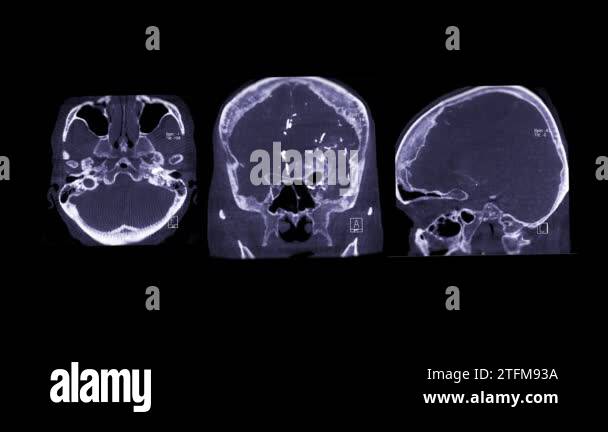 Angiogram of blood clot Stock Videos & Footage - HD and 4K Video Clips ...