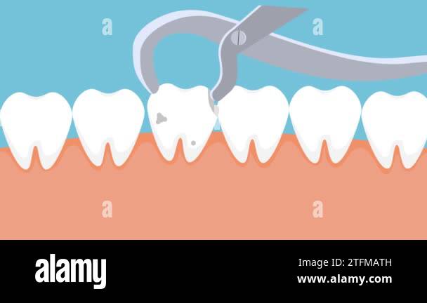 Removing dead tooth with a dental nipper on a green screen and alpha ...