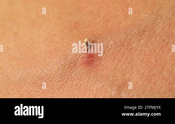 Bee's venom sac. Honey bee stings a man's arm. When the sting is over ...