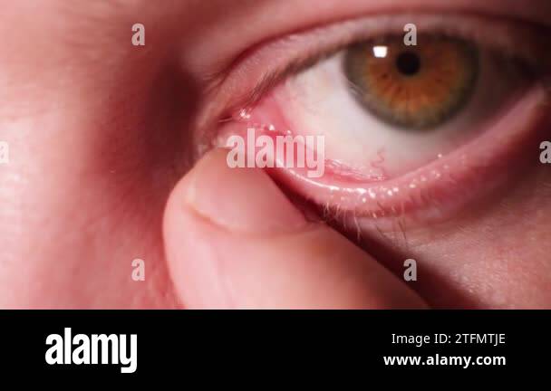 Macro video of the mans eye, the mucous membrane of the conjunctiva ...
