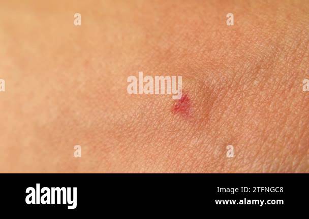 Bee sting on the arm of a man. Stung by a worker bee .skin allergy ...