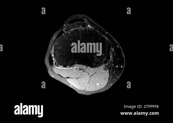 Mri Knee Joint Dynamics Of Scrolling Through Mri Images Magnetic Resonance Imaging Of Right