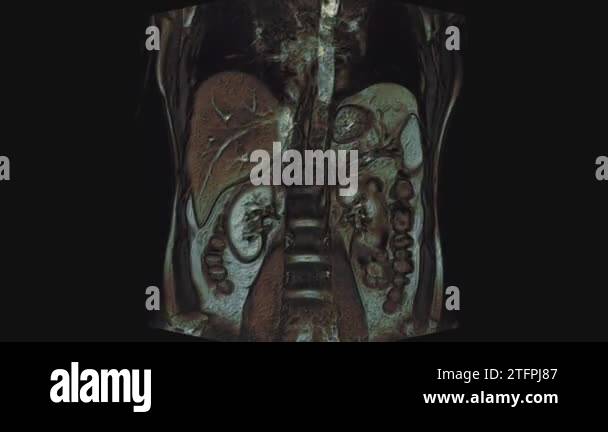 Bulk multicolored CT scan of the abdomen. Computed tomography of the ...