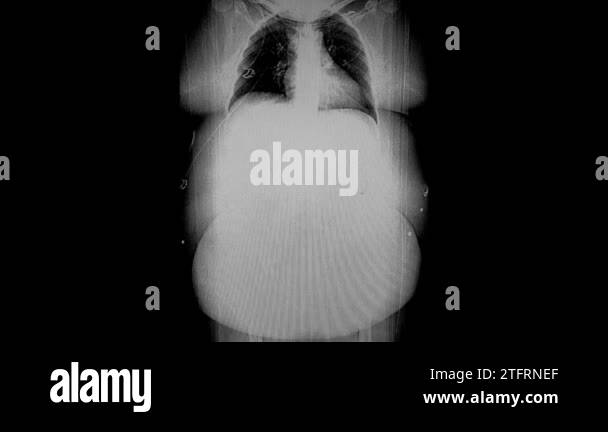 Morbidly obese person - alternating lateral and frontal x-rays Stock ...