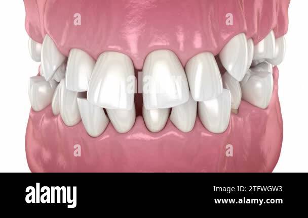 Abnormal teeth position, correction process. Medically accurate dental ...