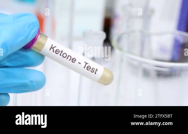 Urine samples for testing Ketones in the laboratory, urine sample in ...