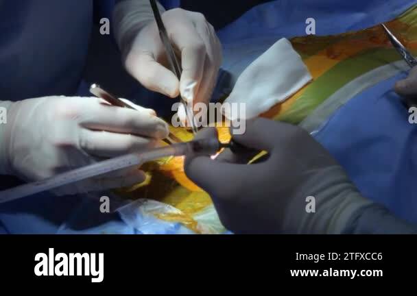 The neurosurgeon performs ventriculo-peritoneal shunting. Shunt medical ...