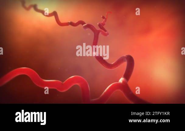 Rupture blood vessel Stock Videos & Footage - HD and 4K Video Clips - Alamy