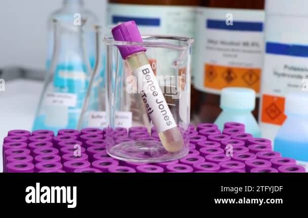 Urine samples for testing Bence Jones in the laboratory, urine sample ...