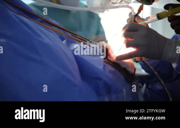 Treatment of a brain aneurysm. Surgical operation on the brain. A team ...