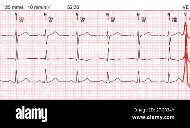 Electrocardiogram examination Stock Videos & Footage - HD and 4K Video ...