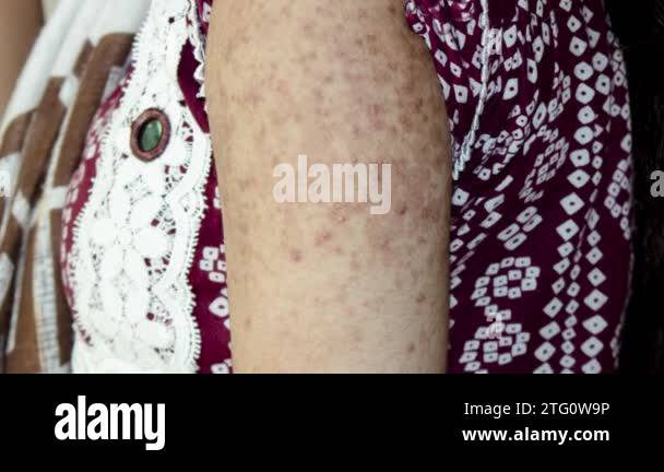 Close up dermatitis on the skin, fungus allergy, Fungus of skin, The ...