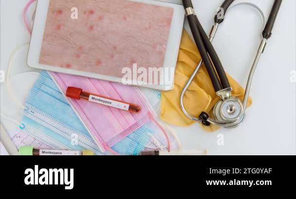 Sample blood test of Monkeypox in laboratory with doctor examination ...