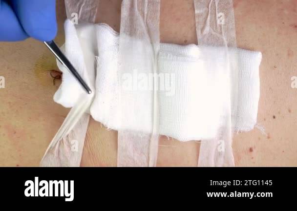 Medical sutures, stitch after surgery, stitched surgical sutures on ...