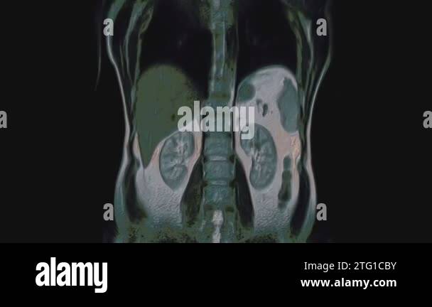 Bulk multicolored CT scan of the abdomen. Computed tomography of the ...