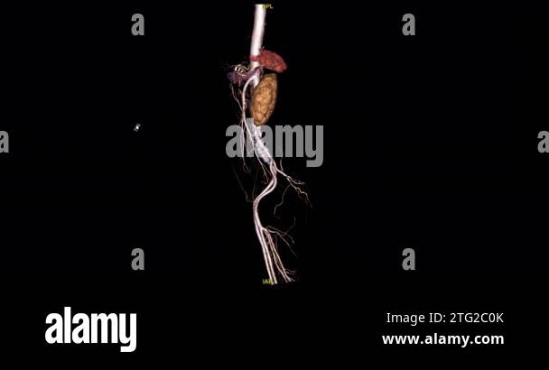 CTA abdominal aorta 3D rendering turn around on the screen for ...