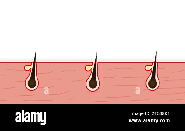 Body hair removal from the root using laser 4K animation. Removing hair ...