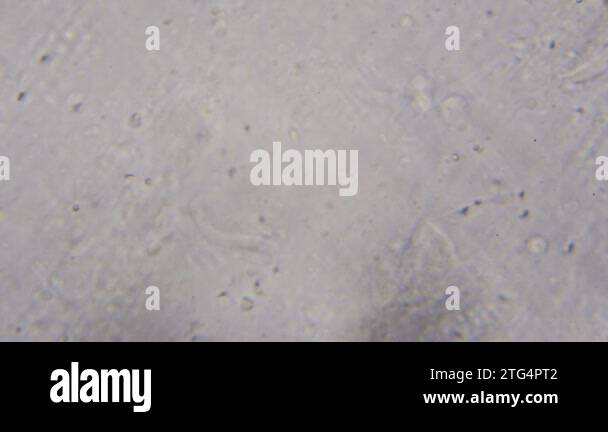 Live human sperm (spermatozoa motion) under microscope Stock Video ...