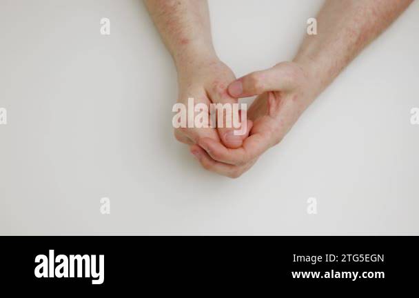 Human scratches hands, fingers with itchy red spots on skin. Seasonal ...