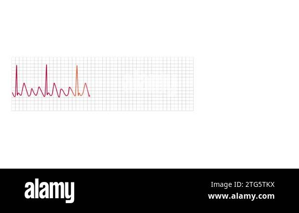 Animated electrocardiograph monitor graph that shows atrial flutter ...