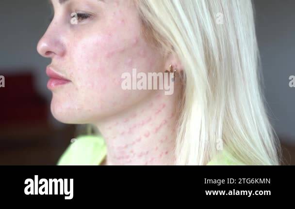 Real skin Biorevitalization on white background. Traces of ...