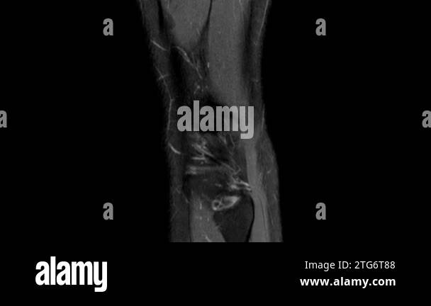 Dynamic scrolling through MRI images of knee joint. Diagnosis sport ...