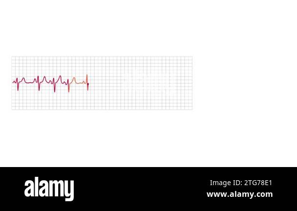Arrhythmia ecg monitor Stock Videos & Footage - HD and 4K Video Clips ...
