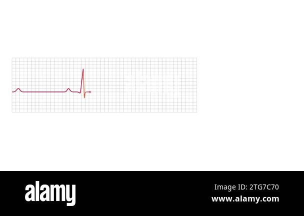 Animated electrocardiograph monitor graph that shows atrioventricular ...