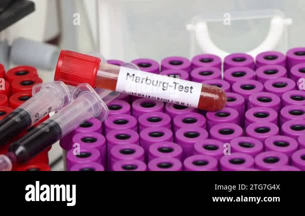 Marburg test to look for abnormalities from blood, blood sample to ...