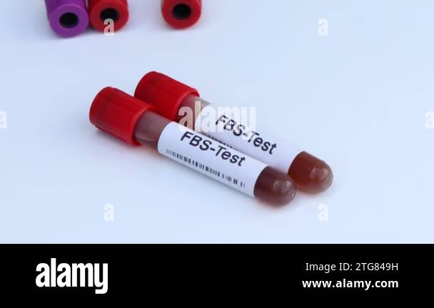 FBS test to look for abnormalities from blood, blood sample to analyze ...