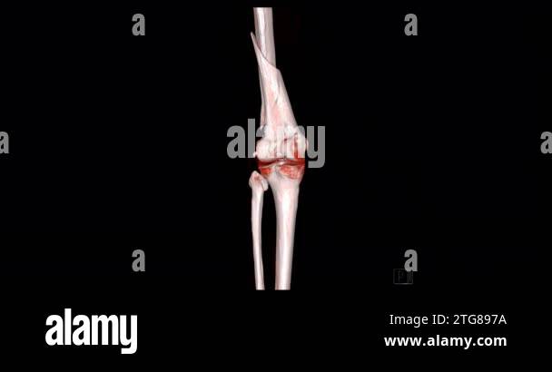 Knee 3D from CT Scan of knee joint 3d rendering image turn around on ...