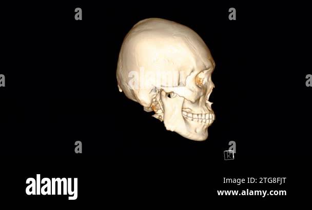 Skull 3D from CT Scan of facial bone 3D rendering showng human skull ...