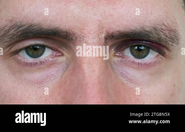 A real black eye on the young male face. A bruise on a mans eyelid ...