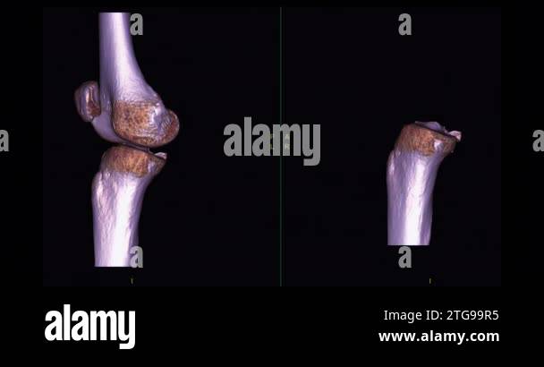 Knee 3D from CT Scan of knee joint 3d rendering image turn around on ...