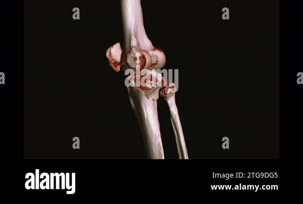 Knee 3D from CT Scan of knee joint 3d rendering image turn around on ...