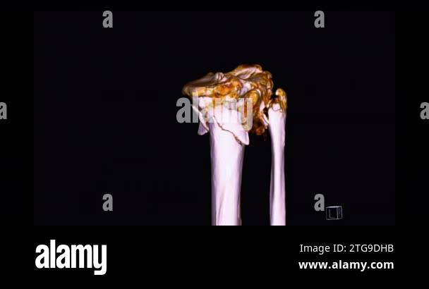 Knee 3D from CT Scan of knee joint 3d rendering image turn around on ...