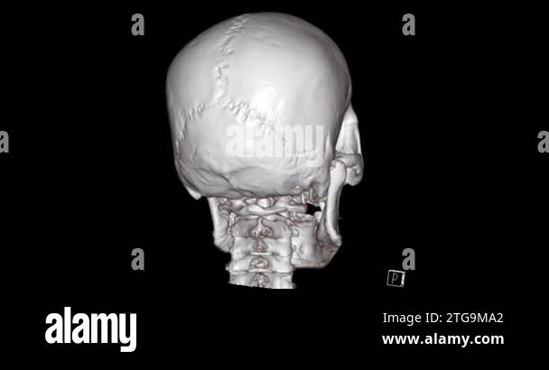 Skull 3D from CT Scan of facial bone 3D rendering showng human skull ...
