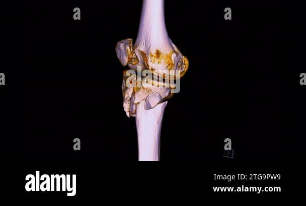 Knee 3D from CT Scan of knee joint 3d rendering image turn around on ...