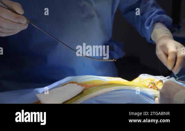 The neurosurgeon performs ventriculo-peritoneal shunting. Surgery for ...