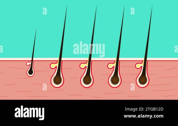Removing body hair from the hair root by using laser treatment 4K ...