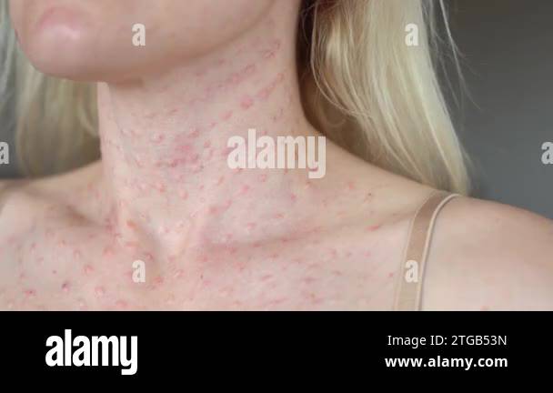 Real skin Biorevitalization on white background. Traces of ...