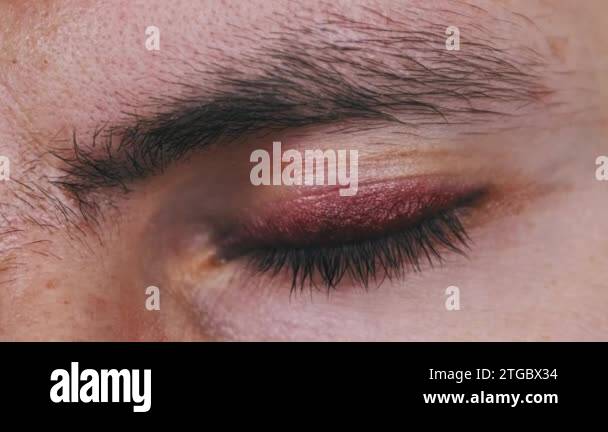 A real black eye on the young male face. A bruise on a mans eyelid ...
