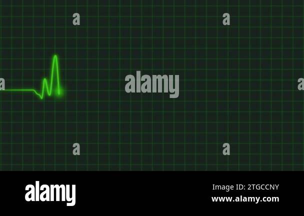Electrocardiography of the heartbeat. Motion moves the heart on the ...