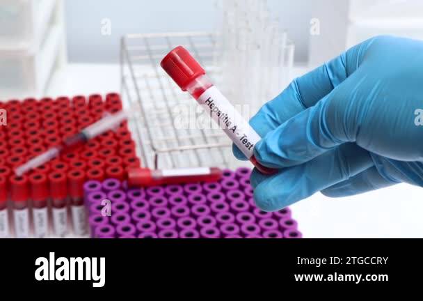 Hepatitis A test to look for abnormalities from blood, blood sample to ...